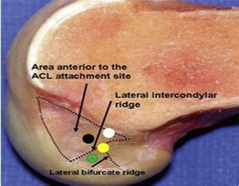Sagittal Cut Of Right Side Of Distal Femur Just Lateral To Center Of Download Scientific