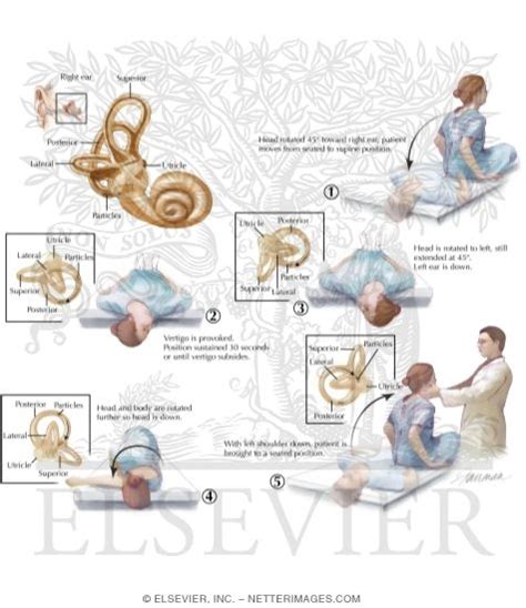Self Canalith Repositioning Maneuver