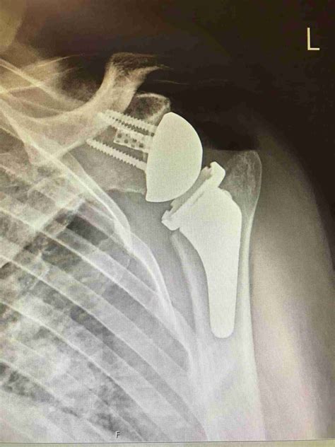 Reverse Shoulder Replacement And Recovery Melbourne Arm Clinic