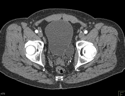 Bladder Diverticulum Genitourinary Radiology Case Studies Ctisus Ct