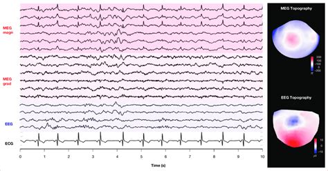 2 Pulse Artifact Seen In Simultaneous Meg And Eeg Recordings Obtained Download Scientific