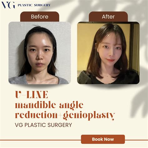 We Specialize In V Line Surgery A Procedure Aimed At Refining And