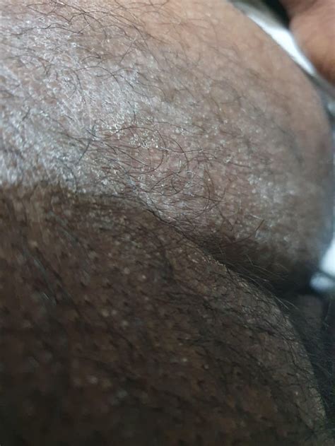 Itchy Inner Thighs Dark Ashy Patches With White Sometimes R