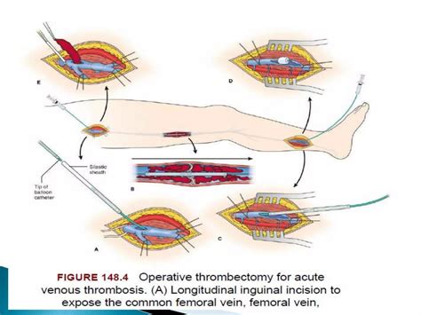 Arterial And Venous Embolectomy Pptx