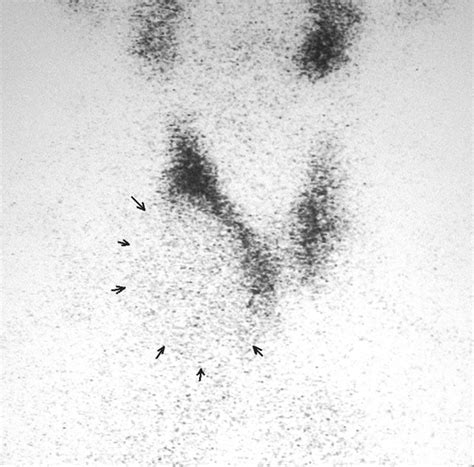 Resection Of An Intrathoracic Thyroid Gland Ctsnet