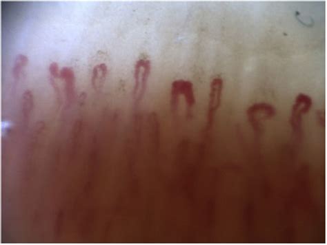 Early Scleroderma Pattern Few Giant Capillaries With No Evidence Of Download Scientific