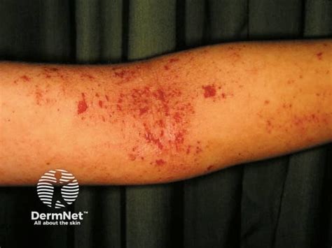 Atopic Dermatitis Image