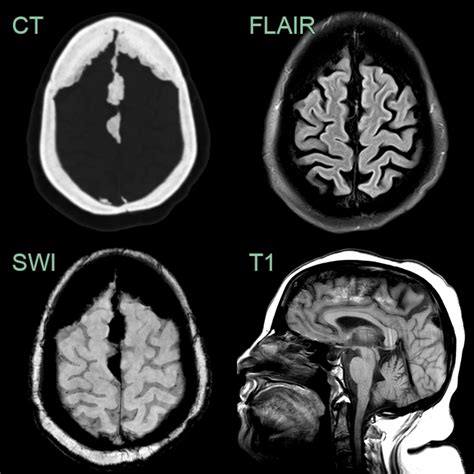 Falx Ossification Neuroradiology