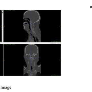FIGURE A Comparison Of Three Dimensional Computed Tomography Download Scientific Diagram