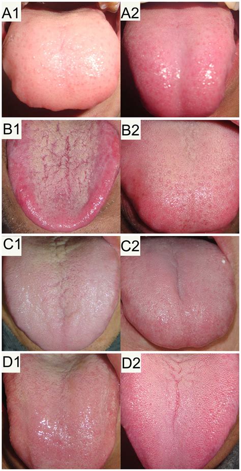 Early Stage Tongue Cancer