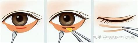 内切眼袋 VS 外切眼袋哪种手术更适合你从6个方面详细说明 知乎