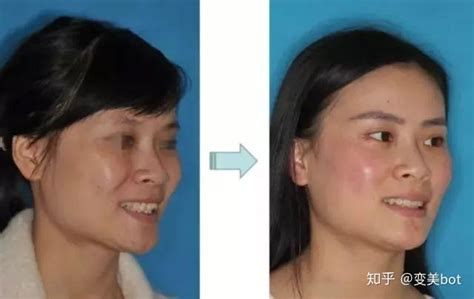 牙齿矫正对外貌变化有多大影响？会变成牙套脸吗？ 知乎