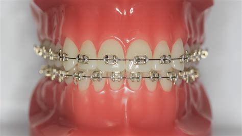 Types Of Braces Which Is Best For You