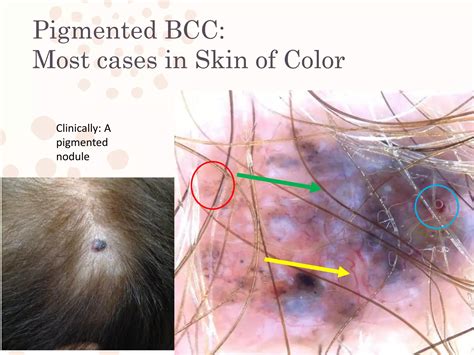 Dermoscopy Bccmbosseila2018 Pdf