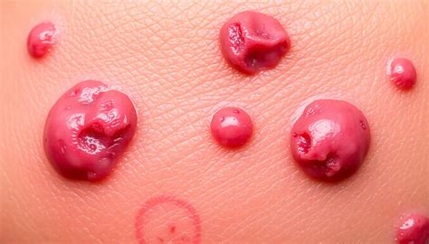 Subcutaneous Nodules Image Free Ai Generator Makepix