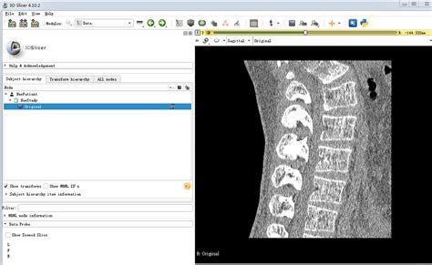 nrrd格式转换成png图像并且输出轴位冠状位和矢状位图像求助 来自 spine 问题求助 DSlicer中文论坛
