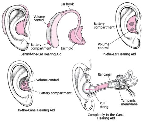 Management Of Hearing Loss Management Of Hearing Loss Merck Manual