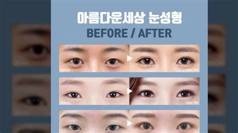 연예인쌍꺼풀수술 어디서 할까 20년이상의 경력 원포인트유착법으로쌍커풀수술후기 네이버 Tv