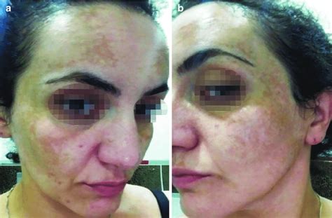 1 A And B Bilateral Light Brown Patchy Hyperpigmentation With