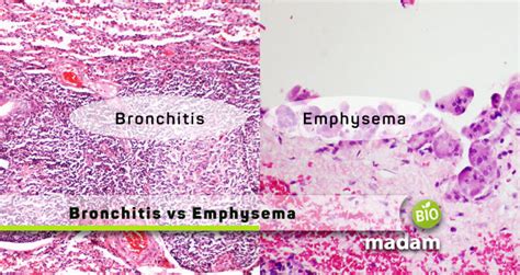 Difference Between Chronic Bronchitis And Emphysema Biomadam