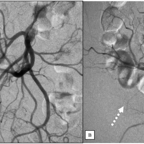 A Pre Embolization Arteriogram Demonstrated The Hypervascular Download Scientific Diagram