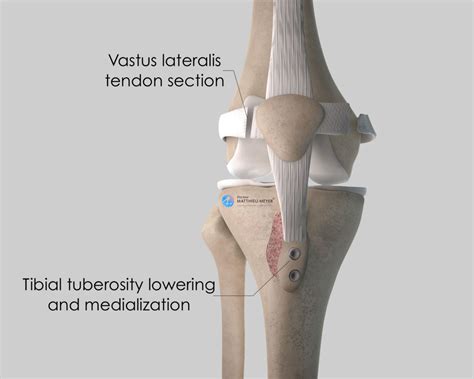 Anterior Tibial Tuberosity Transfer Patella Realignment Doctor