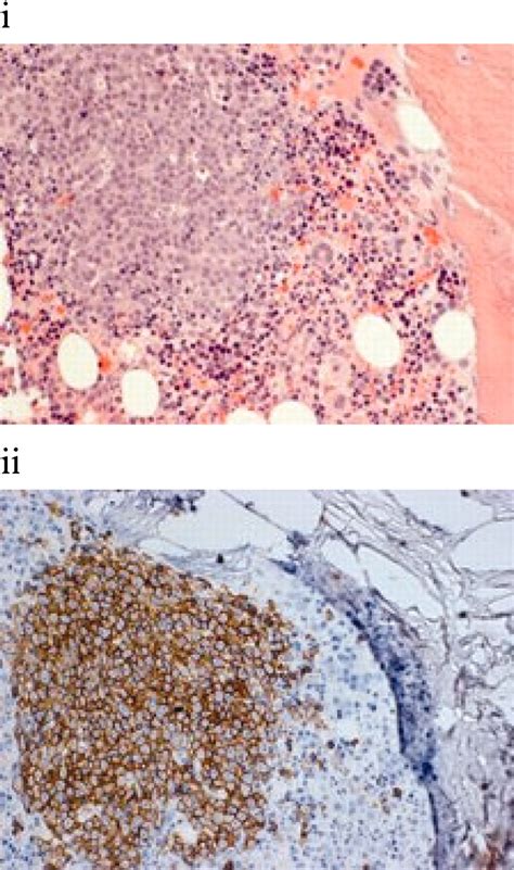 An Unusual Case Of Relapsing Remitting Mononeuritis Multiplex Bmj