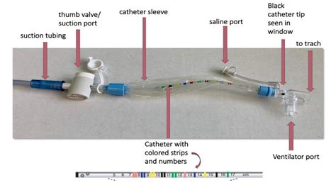 Inline Suctioning Procedure At Scott Lanier Blog