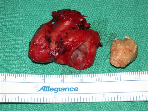 Salivary Gland Conditions