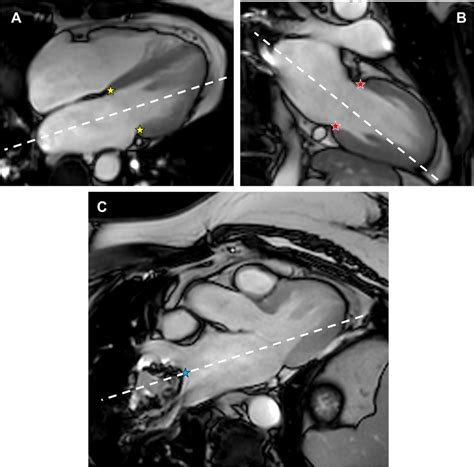 Frontiers How Can The Left Atrial Strain Be Correctly Determined By Cardiovascular Magnetic
