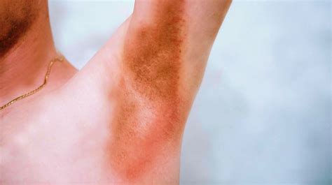 Inverse Psoriasis Bilder Ursachen Und Behandlungen Symptome