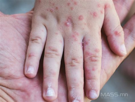 Улаанбурхан өвчний 11 дэх тохиолдол батлагдлаа