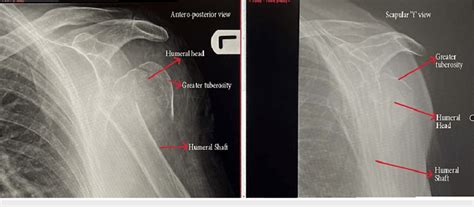 Comminuted Proximal Humerus Fracture Treatment Of Proximal Humeral