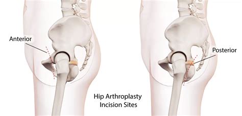 Anterior Hip Replacement Surgery Procedure And Its Advantages Orthopedic Implants