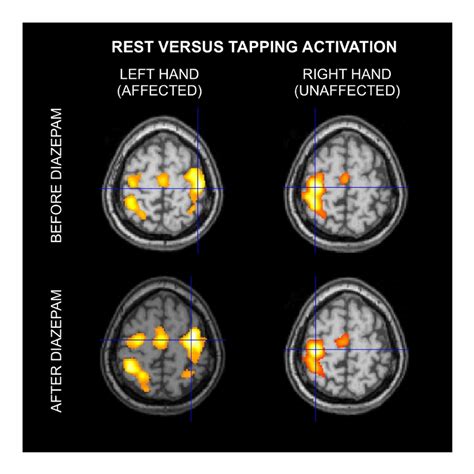 Brain Activation Maps Obtained By The Analysis Of Fmri Scans Showing Download Scientific