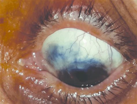 Diffuse Scleritis In The Superotemporal Part Of The Left Eye Superior