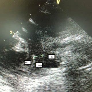 Transthoracic Echocardiogram PDA Patent Ductus Arteriosus Download Scientific Diagram