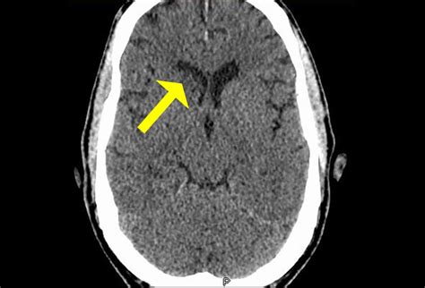 8 Causes Of Altered Mental Status In The Elderly