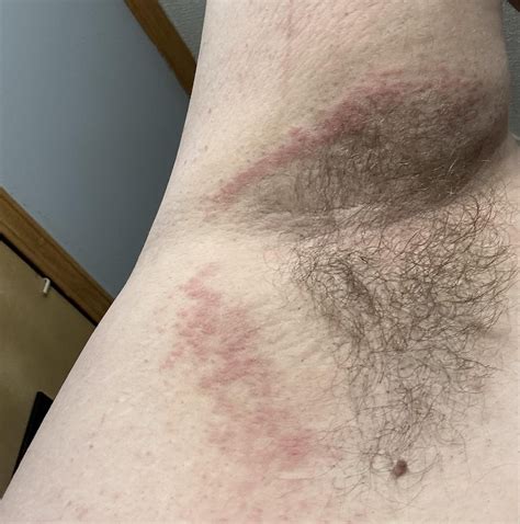 Hiv Rash Rhiv