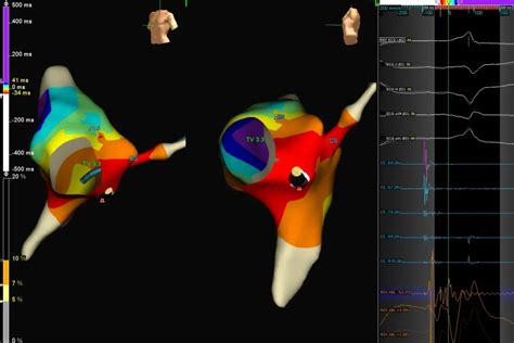 What Is Cardioneuroablation Prof Dr Taylan Akgün