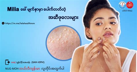 “milia လို့ခေါ်တဲ့ အဆီဖုလေးများ” May 2023 တယ်လီကျန်းမာ