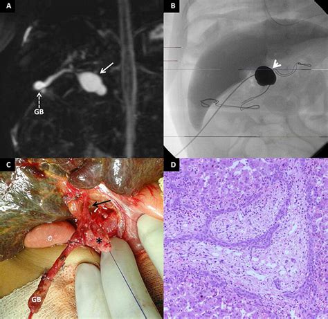 Cystic Biliary Atresia
