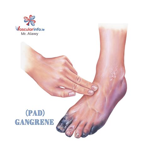 Femoral Popliteal Bypass Vascular Info