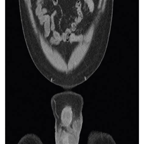 Diagnostic Imaging A Scrotal Ultrasound Depicting Hypoechoic