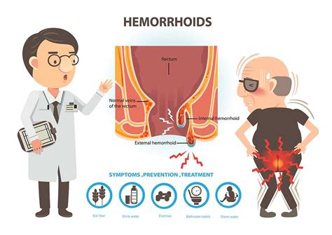 Hemorrhoids Symptoms Causes Diagnosis Treatment And Prevention Page 7