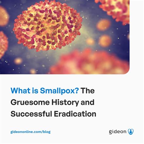 Gideon® On Linkedin What Is Smallpox The Gruesome History And