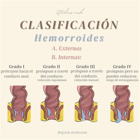 Hemorroides Externas Cie 10