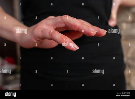 Chilblains On Fingers Red Itchy Bumps Hand Of Person With Raynauds Phenomenon And Chilblains