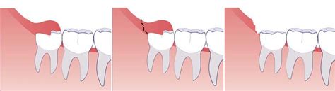 Operculectomy News Dentagama