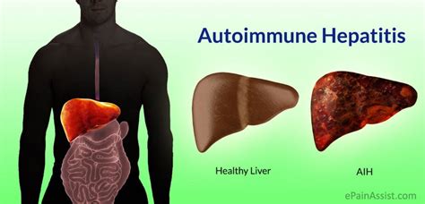 Autoimmune Hepatitis Symptoms Causes And Risk Factors